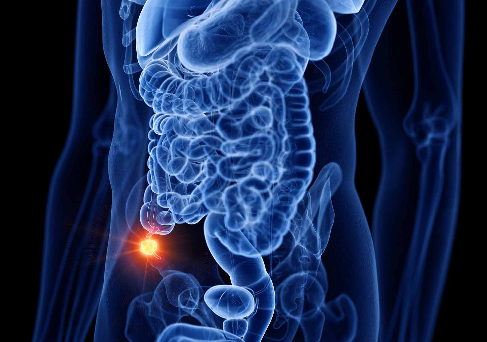 Expert Appendicitis Treatment by Dr. Mahmoud Tabbal - Appendicitis ...